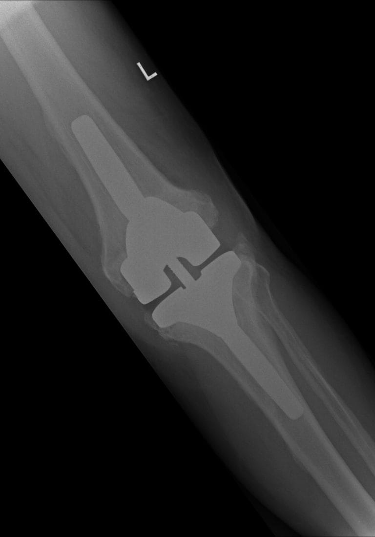 Revision Knee Replacement Surgery | Mr Arun Kumar | Manchester